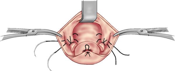 Manchester Operation (Fothergill Repair) - medglobalsolution.com